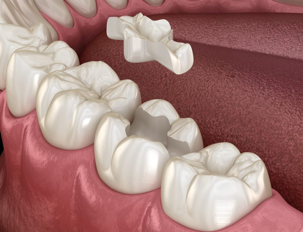 Inlays and Onlays College Station | Dental Care